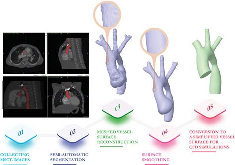 Scheme Of The Vessel Surface Reconstruction From An Array Of Download Scientific Diagram