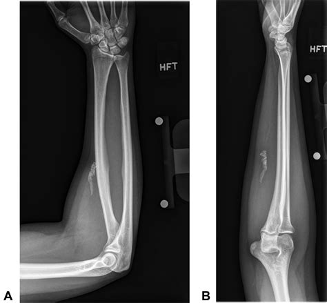 Calcific Tendinitis Of The Proximal Flexor Carpi Radialis In A Throwing Athlete Journal Of