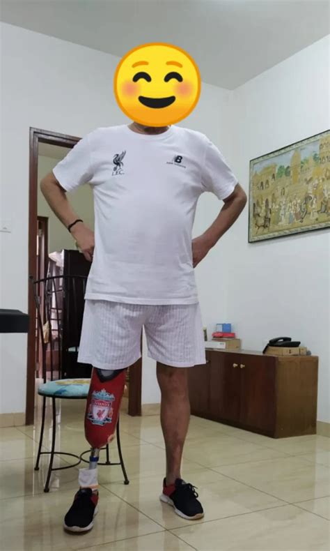 Below Knee Prosthesis With Carbon Fiber Foot Shree Mahalaxmi