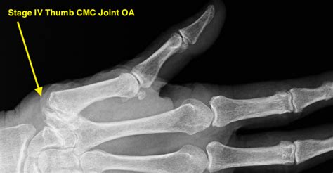 Osteoarthritis Carpometacarpal Cmc Joint Of Thumb Hand Surgery