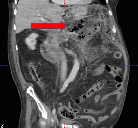 Step Up Approach For The Management Of Pancreatic Necrosis A Review Of