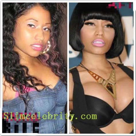 Nicki Minaj Breast Reduction Before And After