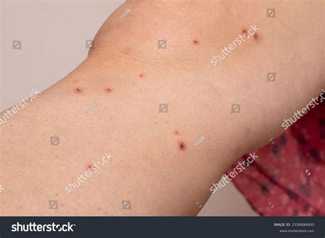 Itchy Scab