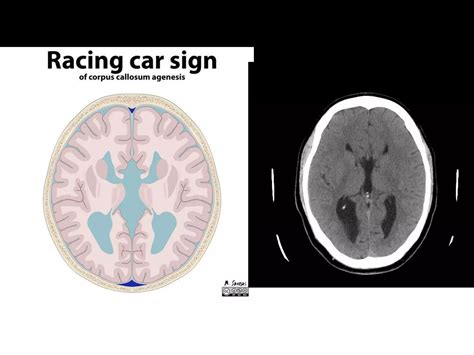 Congenital Brain Anomalies Pdf