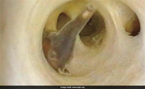 China Doctors Find Wriggling Worms Inside 70 Year Old Mans Abdomen