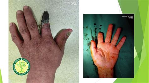 ШАРХНЫ ХАЛДВАРЫН ШАЛТГААН ХҮНДРЭЛИЙН ДАРААХ ТОХИОЛДОЛ УРЬДЧИЛАН СЭРГИЙЛЭХ АРГУУД ️ ️ ️