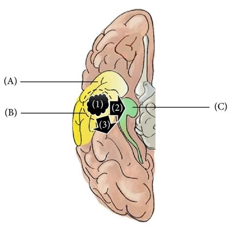 Options In Lesional Neocortical Temporal Lobe Epilepsy Ntle Surgery Download Scientific