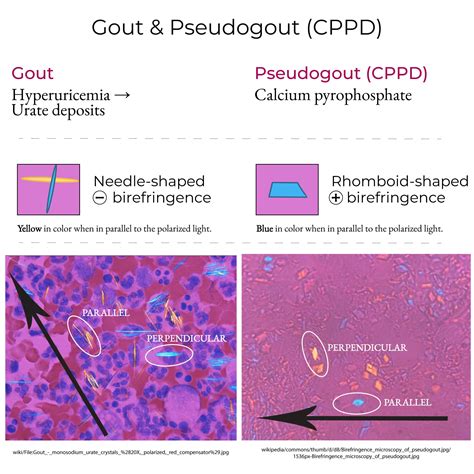 Clinical Pathology Glossary Pseudogout Aka Cppd Ditki Medical