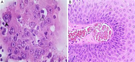 He ×400 Histopathologic Examination Enlarged Hyperchromatic Nuclei Download Scientific Diagram