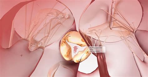 Premium Photo Calcified Aortic Valve Cannot Open Completely