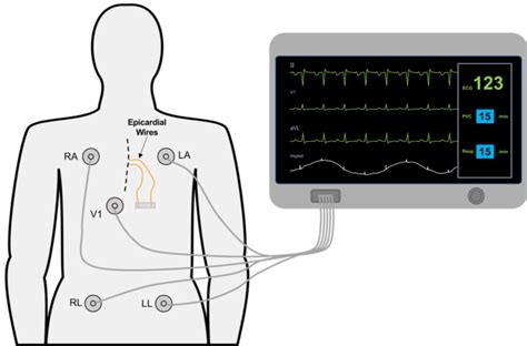 Display Of The Surface And Atrial Electrogram Atrial Electrogram
