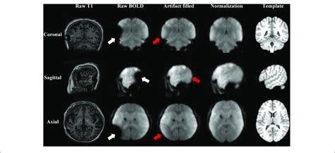 Resting State Fmri Data Preprocessed After The Deep Brain Stimulation Download Scientific