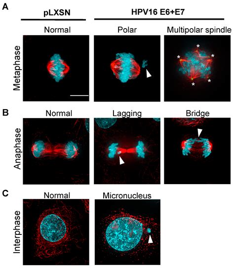 Human Papillomavirus Induced Chromosomal Instability And Aneuploidy In Squamous Cell Cancers