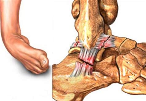 Pijnlijke Enkels Verstuikte Voet Enkel Verzwikt