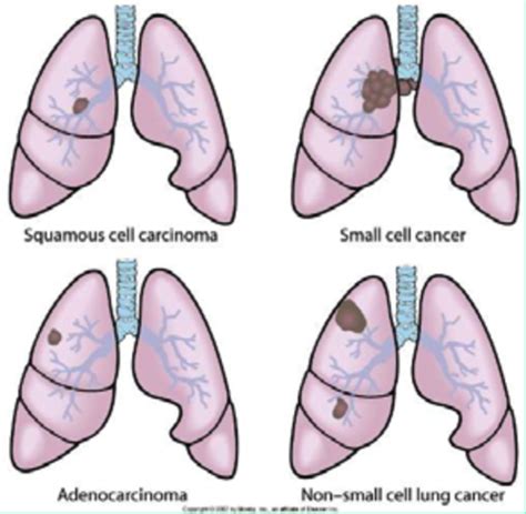 Lecture 5 Anaphylaxis And Lung Cancer Flashcards Quizlet