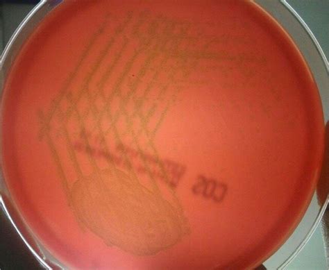 Culture Of Aspirated Vitreous Fluid Shows Growth Of Streptococcus Mitis