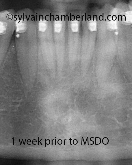 Osteogenesis By Symphyseal Mandibular Distraction Dr Sylvain