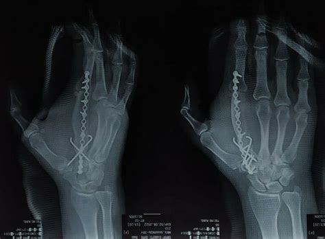 Dr Najmul Hasan On Linkedin Gct Rt 2nd Metacarpal Wle And Reconstruction By Tricortical Illiac