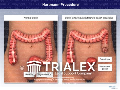 Hartmanns Procedure