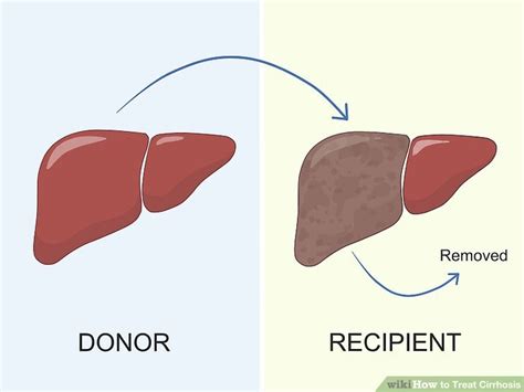 3 Ways To Treat Cirrhosis Wikihow Health