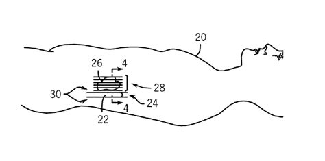 System And Method For Intracorporeal Elastography Eureka Patsnap