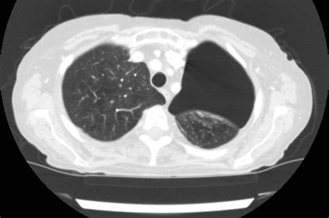 Lung Window Ct Examples Windowing Radiology 1st Wave