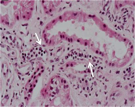 Test Your Knowledge Immunology And Transplantation Ajkd Blog