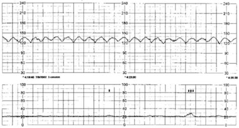 Significance Of A Sinusoidal Fetal Heart Rate Fhr Pattern Barber