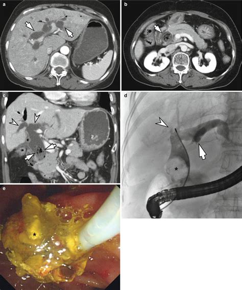 Cholangitis Radiology Key