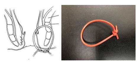 Vaginal Fistula Maher A Abbas Md Proctologist Colorectal Surgeon