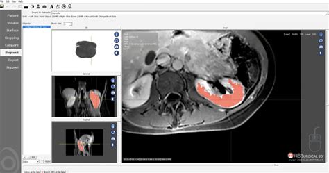 Pro Surgical 3d Stratovan Pro Surgical 3d Stratovan