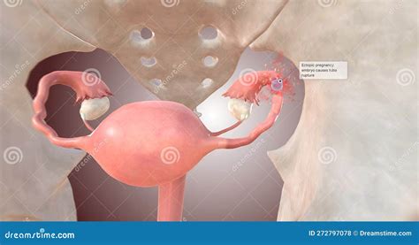 Ectopic Pregnancy Embryo Causes Tube Rupture Royalty Free Stock Image 272797078