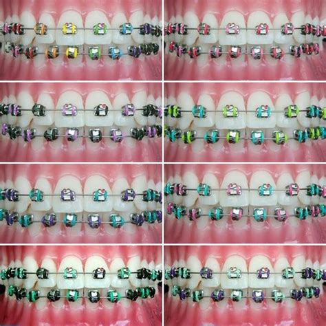Braces Color Ideas Cute Braces Colors Cute Braces Braces Colors