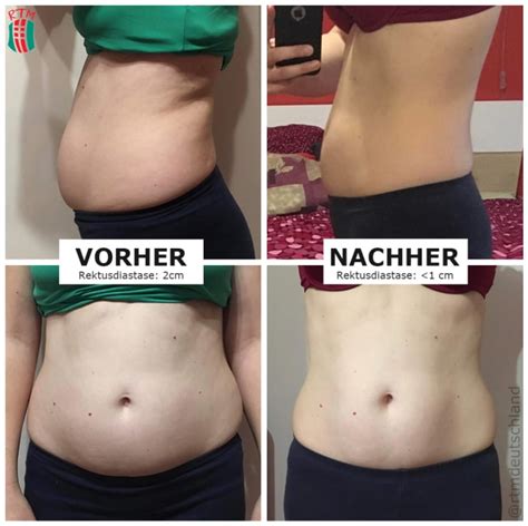 Help You Close Your Rectus Diastasis By Gaalphysio Fiverr