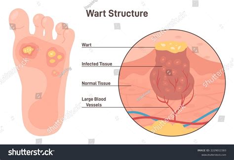 Types Warts Images Stock Photos Vectors Shutterstock