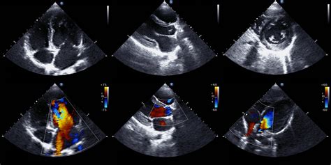 Innovative Ultrasound Technology Allows Early Detection Of Pah In