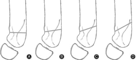 Illustration Of Fracture Angulation In The Sagittal Plane Ad Download Scientific Diagram