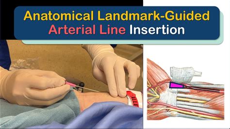 Arterial Line Insertion A Clinical Guide To Best Practices