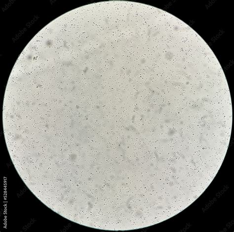 Semen Analysis Under Microscopy Showing Pyospermia Or Leukocytospermia