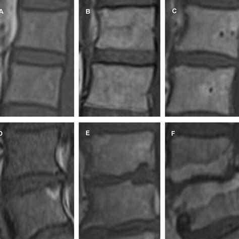 Algorithm For The Classification Of Intervertebral Vacuum Phenomenon Download Scientific