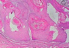 Keratoacanthoma Libre Pathology