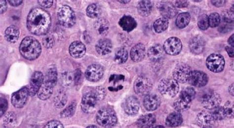 Mitosis Pathology Dictionary MyPathologyReport Ca
