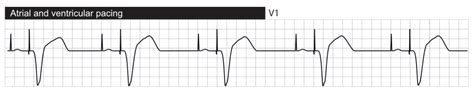 Interpretation Of Pacemaker Ecg The Cardiovascular