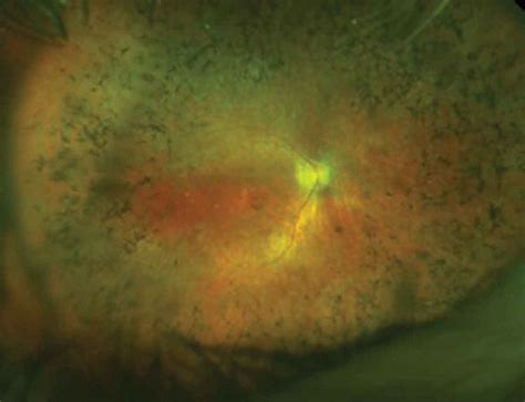 Full Article Gene Therapy For The Treatment Of X Linked Retinitis
