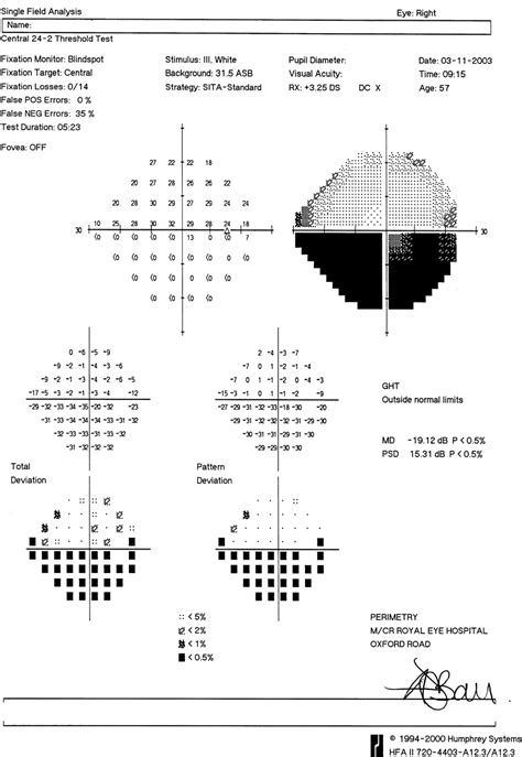 Branch Retinal Artery Occlusion Visual Field Defect