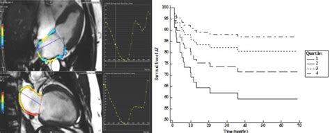 Left Atrial Strain By Cardiac Magnetic Resonance Imaging Predicts Recurrence Of Paroxysmal