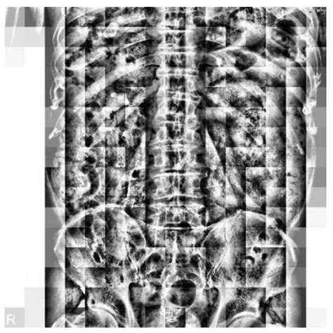 Design And Validation Of A Deep Learning Model For Renal Stone Detection And Segmentation On