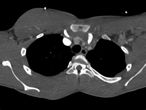Posterior Dislocation Of Left Clavicular Head Musculoskeletal