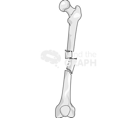 Free Segmental Femur Fracture Icons Symbols Pictures And Images Mind The Graph