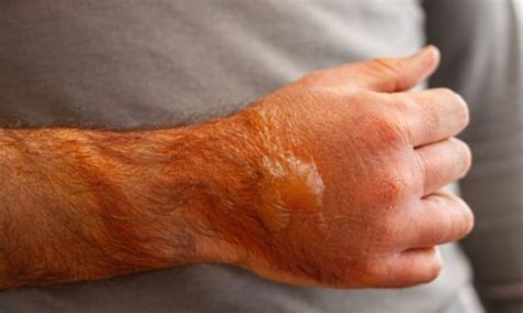 Treating Fractures Essential First Aid Protocols